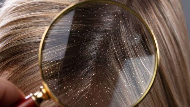 ¿Puede la caspa ser causada por el estrés? - WomanTime Belleza